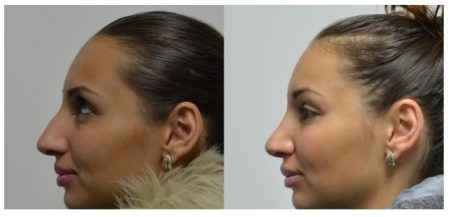 Septoplastie : prix correction deviation cloison nasale